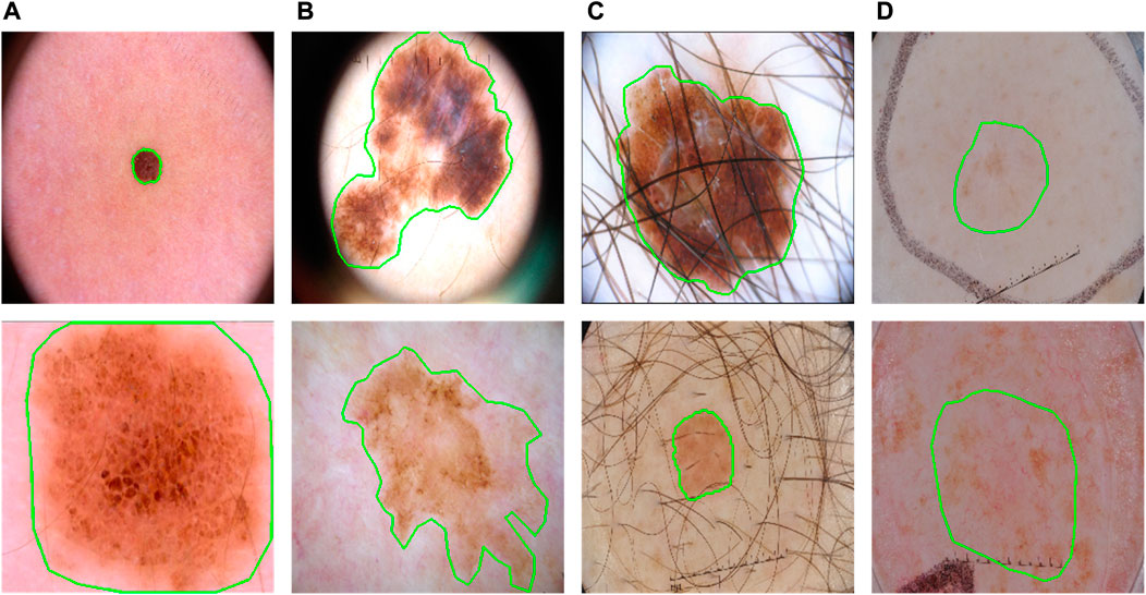 Frontiers | Robust fusion for skin lesion segmentation of dermoscopic ...