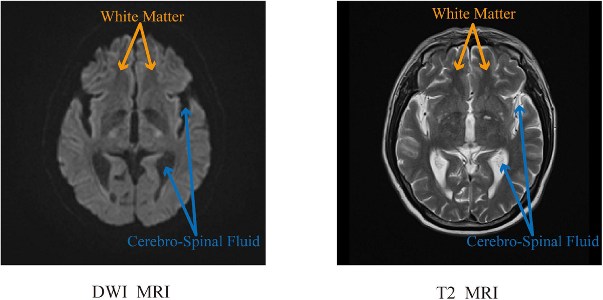 Frontiers | Generative adversarial networks with adaptive normalization for synthesizing T2 ...