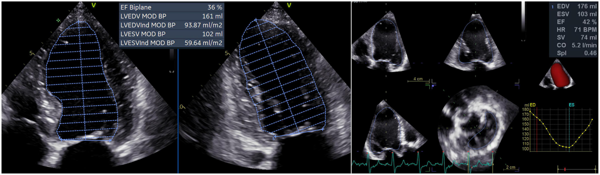 Frontiers Association Of Outcome With Left Ventricular Volumes And