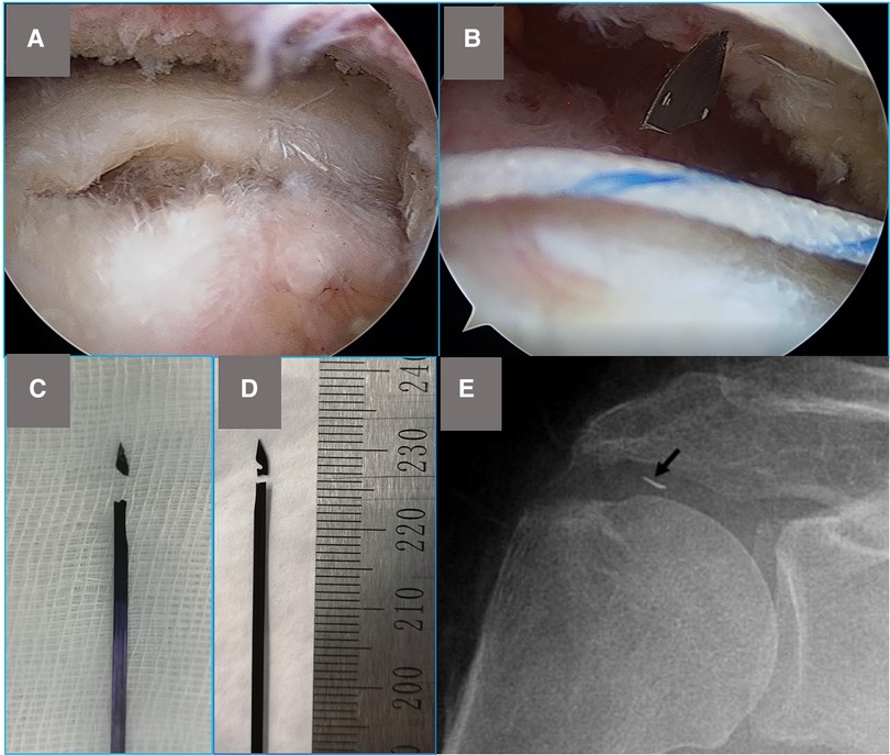 Frontiers | Mechanical mechanism of suture passer needle break in ...