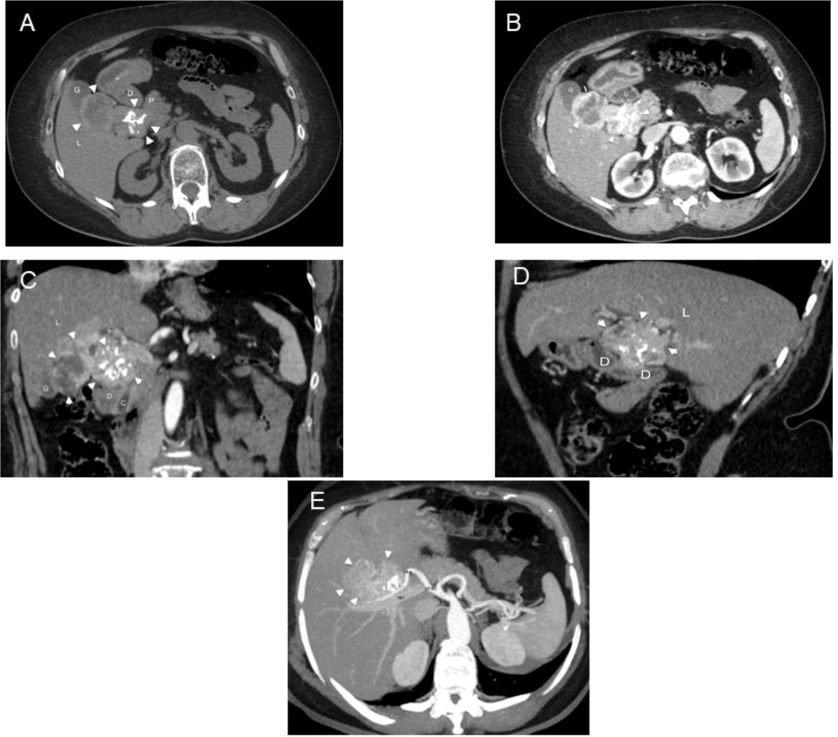 Frontiers | Hepatic incidentaloma: An asymptomatic ectopic thyroid tissue