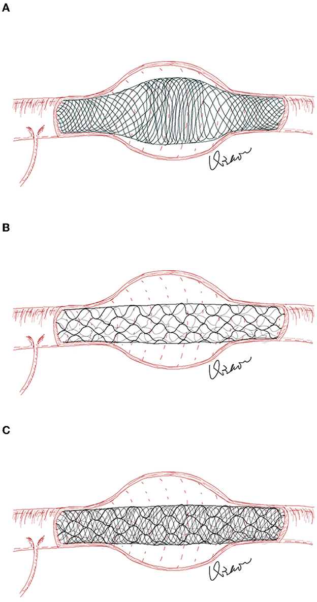 Frontiers | LVIS-within-enterprise double-stent technique with coil ...