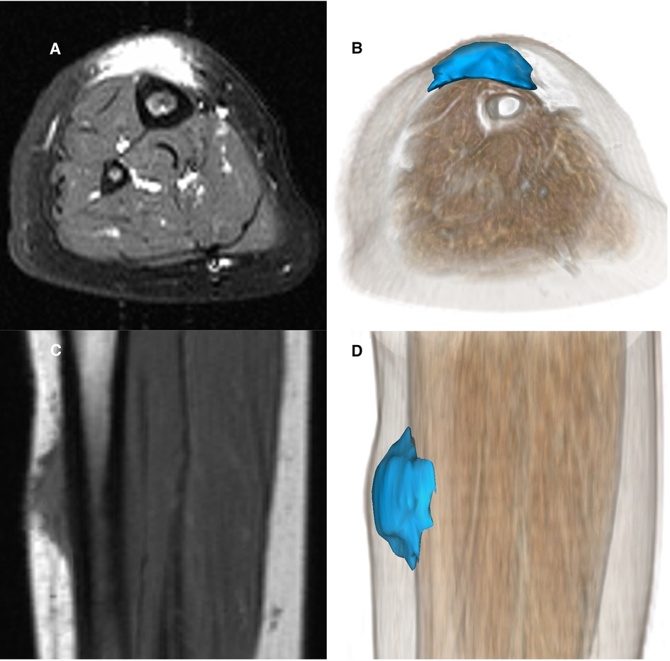 Frontiers | The epifascial cap: A typical imaging sign for subcutaneous ...
