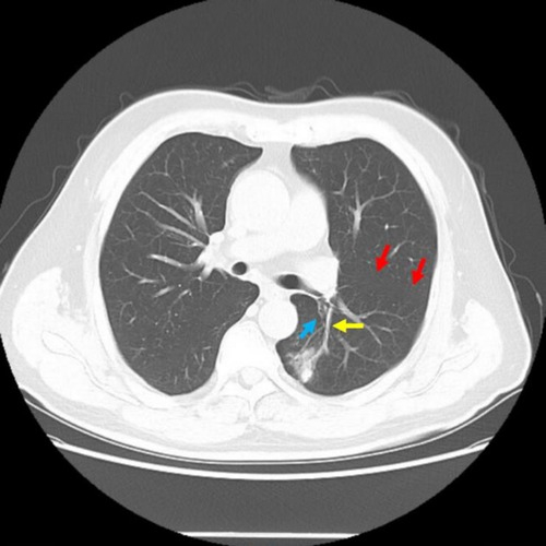 Frontiers | A pulmonary nodule mislocated in “dorsal” segment due to ...