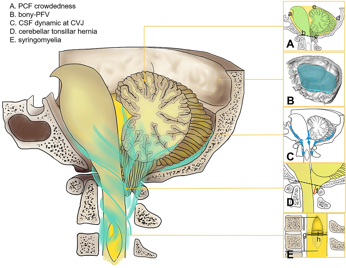 Frontiers | Potential association among posterior fossa bony volume and ...