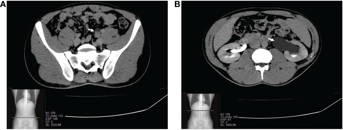 Frontiers | Case report: Primary Ewing sarcoma of the ureter, an ...
