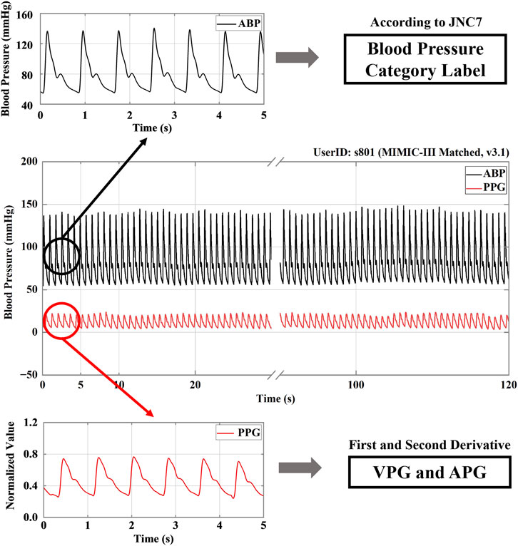 Frontiers | Blood pressure stratification using photoplethysmography ...