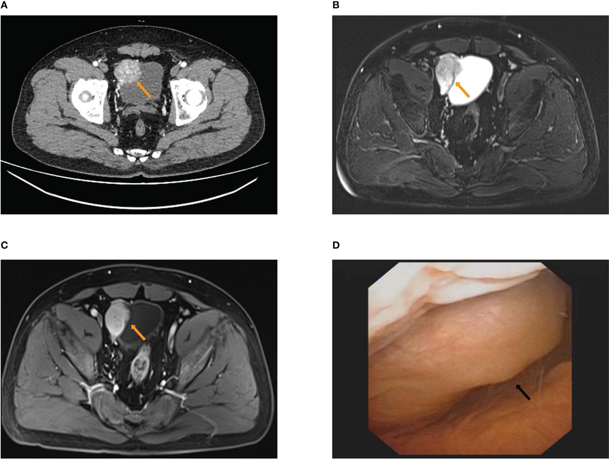 Frontiers | Case Report: Octreotide plus CVD chemotherapy for the ...