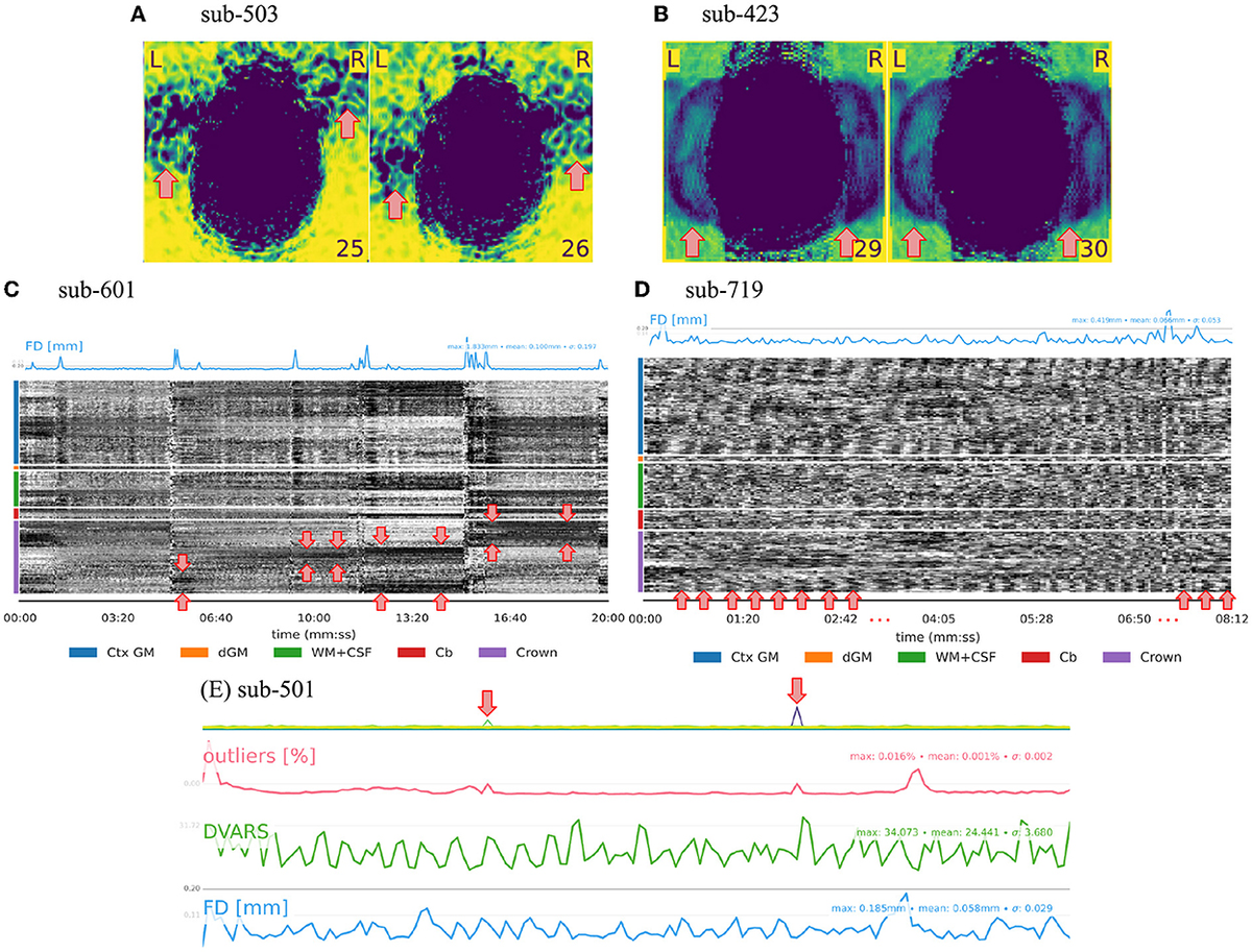 Frontiers | Quality control in functional MRI studies with MRIQC and ...