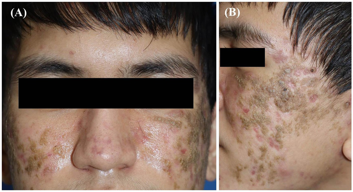 Frontiers | Case report: Dermatosis neglecta mimicking pemphigus ...
