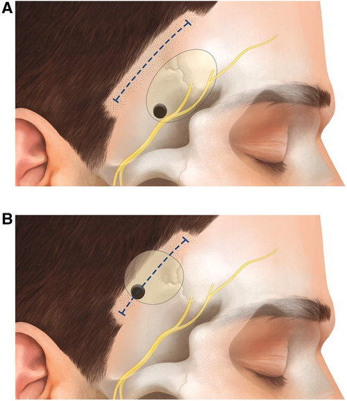 Frontiers | The sylvian keyhole approach for surgical clipping of ...