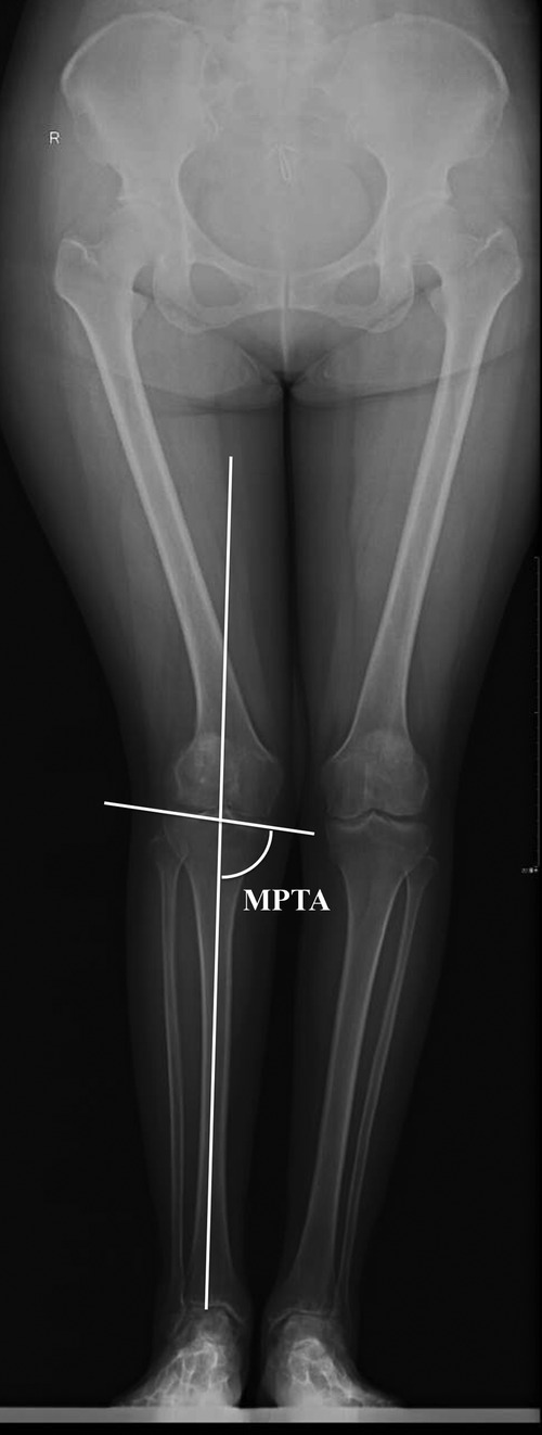 Frontiers | Correlation between tibial valgus deformity and aspect ...