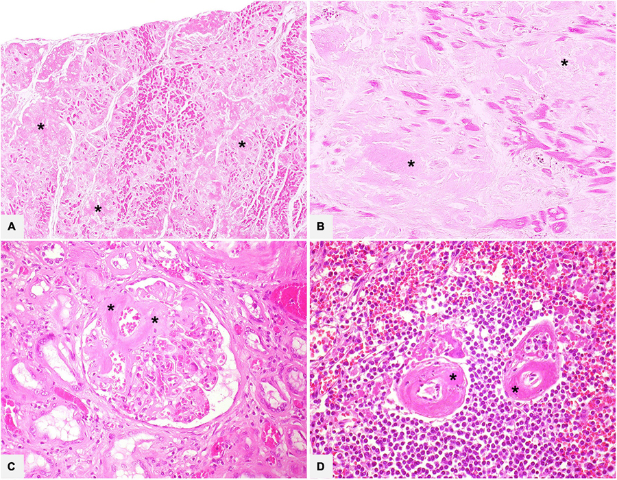 Frontiers | Amyloidosis: What does pathology offer? The evolving field of tissue biopsy