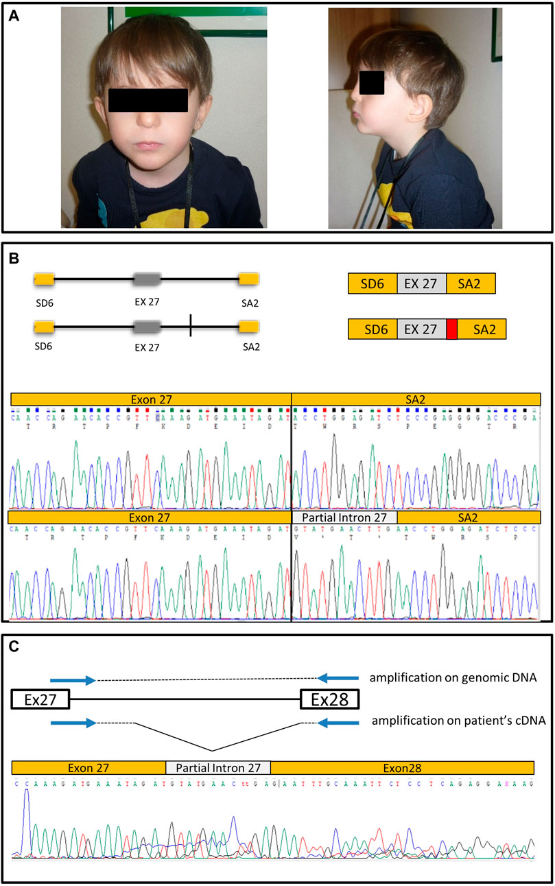 Frontiers | Case report: Functional characterization of a novel CHD7 ...