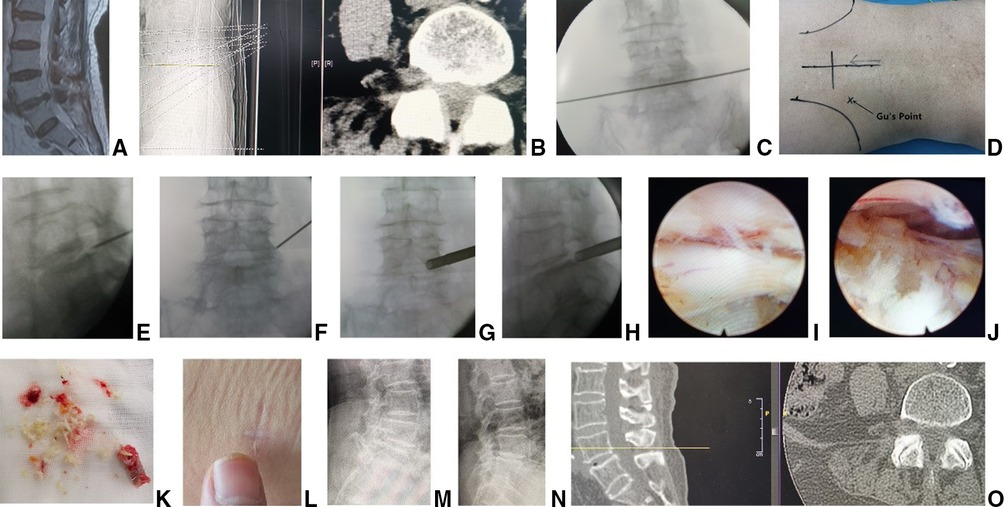Frontiers | Efficacy and safety of percutaneous transforaminal ...