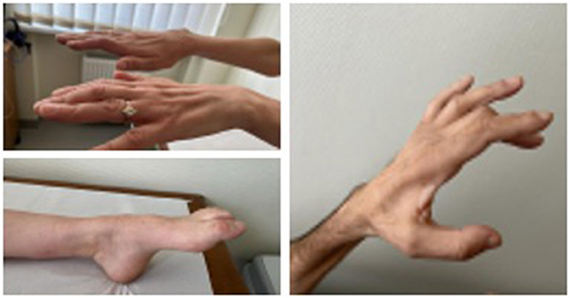 Frontiers | The most common European HINT1 neuropathy variant phenotype ...