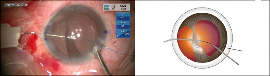 Frontiers | Case report: Double-armed flanged polypropylene suture for ...