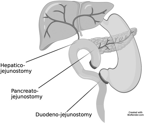 Frontiers | Case report: Pylorus-preserving pancreatoduodenectomy for ...