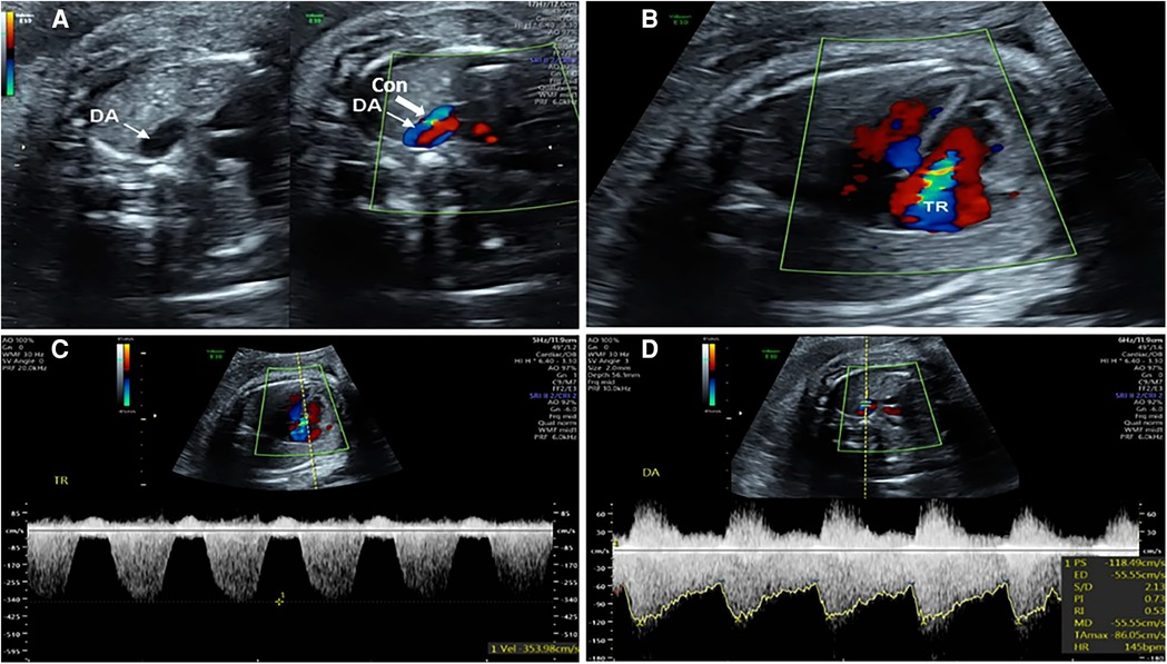 Frontiers | Evaluation of changes of cardiac morphology and function in ...