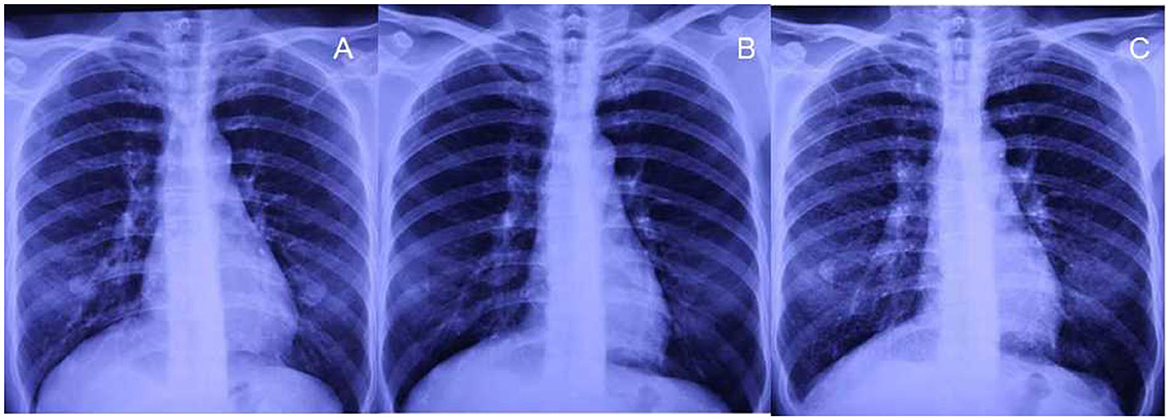Frontiers | Pulmonary sarcoid-like granulomatosis induced by aluminum ...