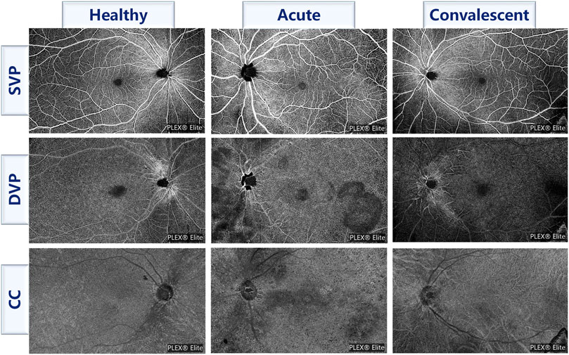 Frontiers | Classification of Vogt-Koyanagi-Harada disease using feature selection and ...