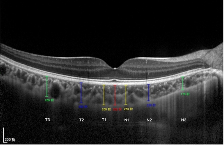 Frontiers | Choroidal thickness and vascular microstructure parameters ...