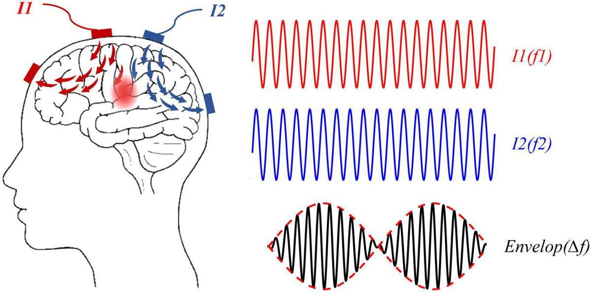 Frontiers | A novel non-invasive brain stimulation technique: “Temporally interfering electrical ...