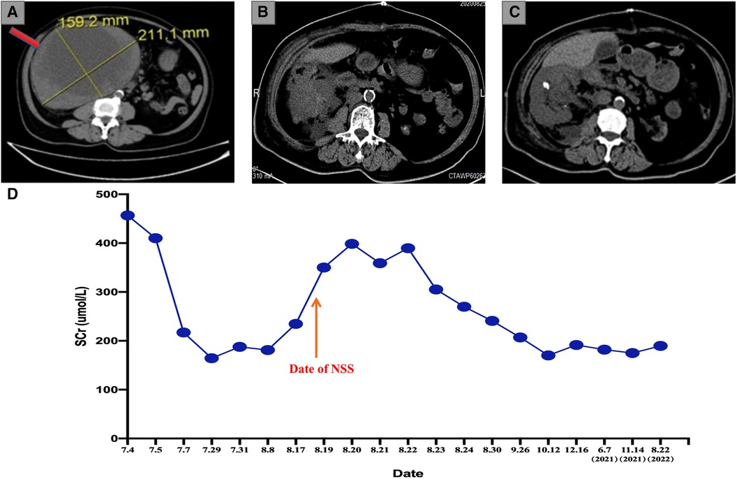 Frontiers | Nephron sparing surgery for a patient with a complicated ...