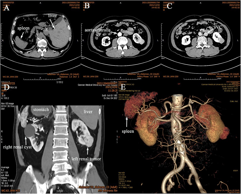 Frontiers | Case report: Robot-assisted laparoscopic partial ...