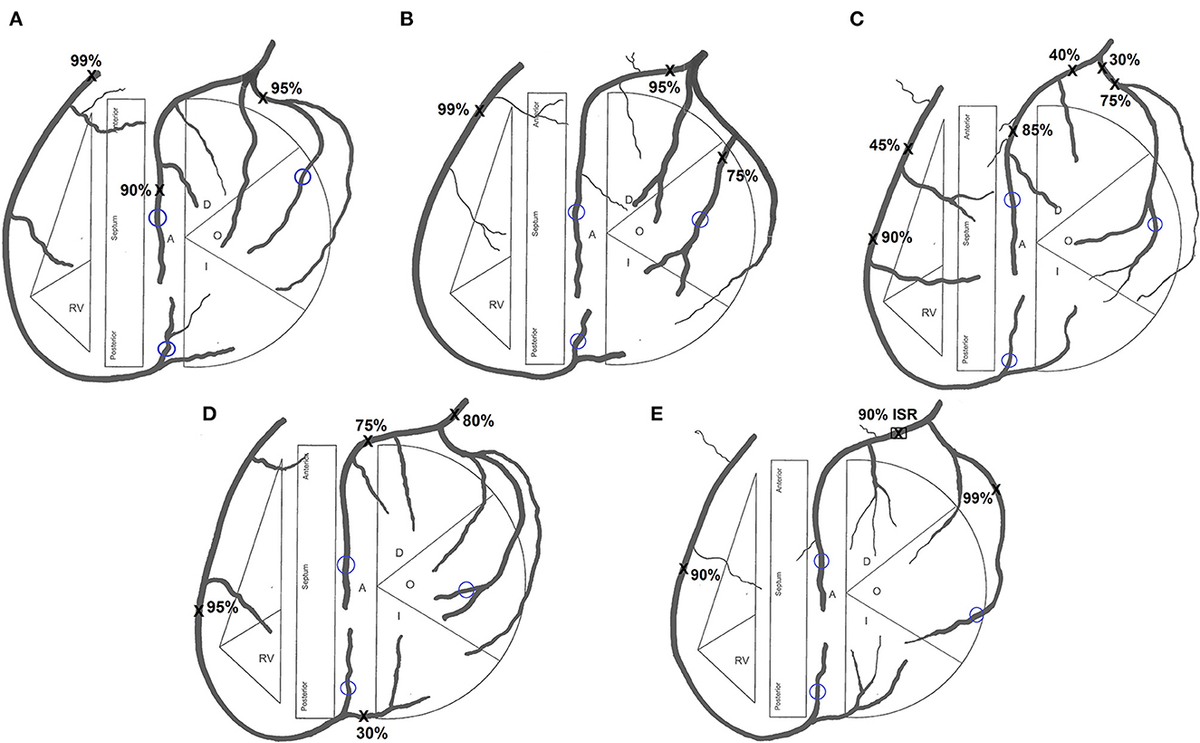 Frontiers | Personalized surgical planning for coronary bypass graft ...