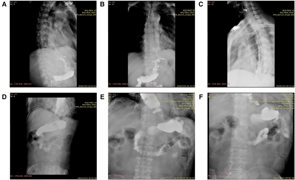 Frontiers | Distal-continual colon interposition for esophageal ...