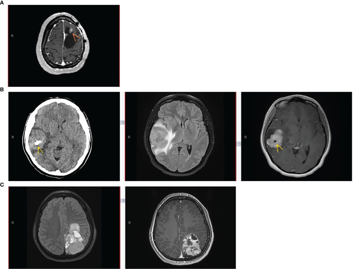 Frontiers | Heterogeneous clinicopathological findings and patient ...