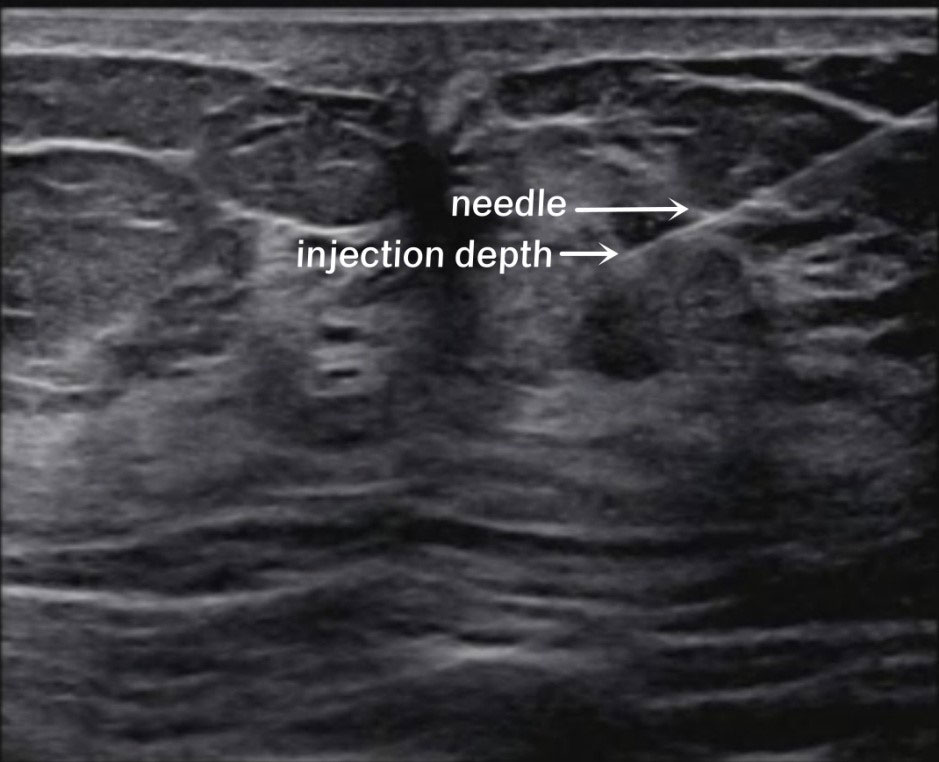 Frontiers | 99mTc-rituximab tracer injection for guiding internal ...