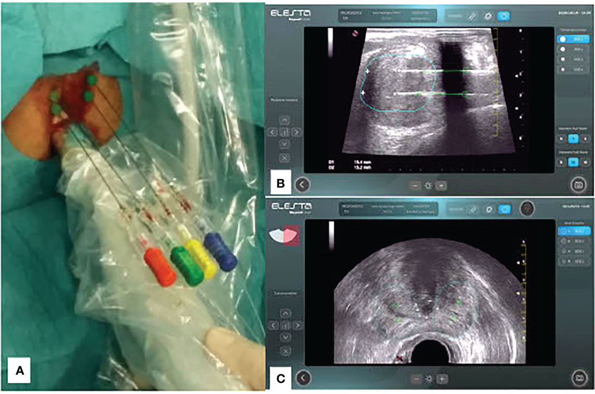 Frontiers | Standard approach and future perspective for the management ...