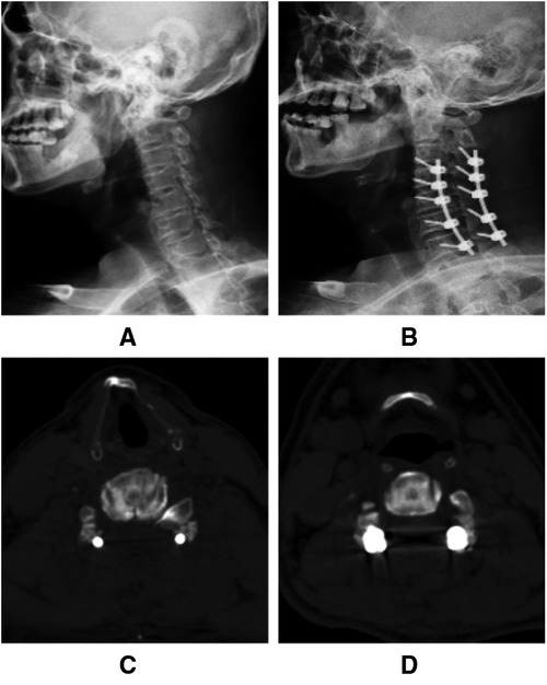 Frontiers | Evaluation of enlarged laminectomy with lateral mass screw ...