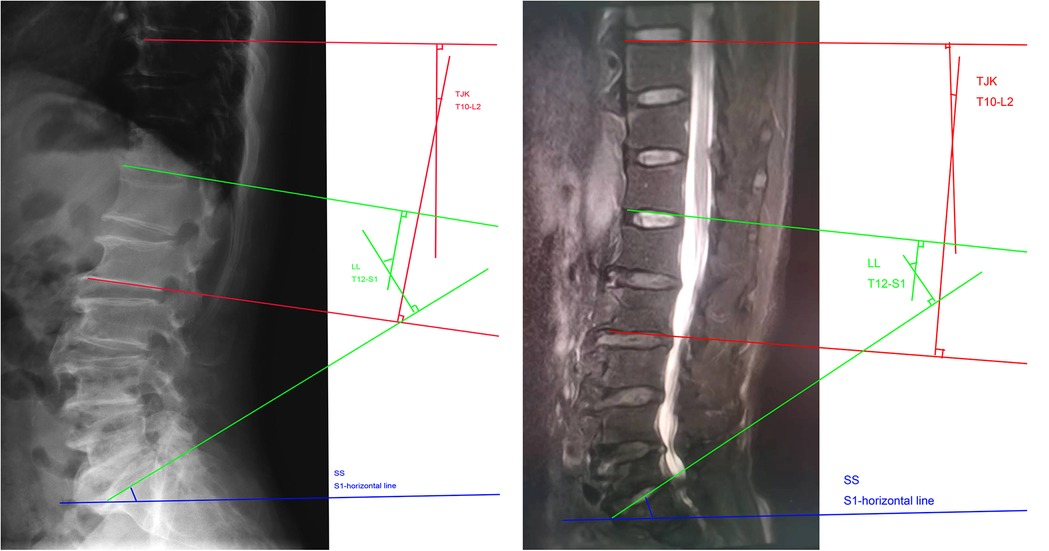 Frontiers | Comparison of sagittal spinal alignment on standing plain x ...