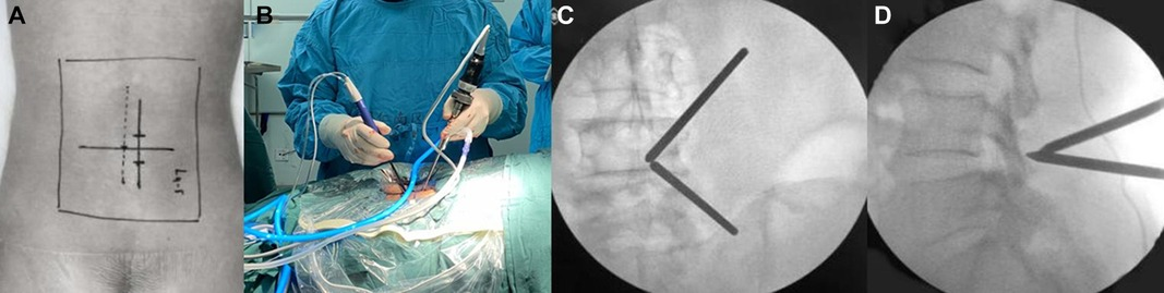 Frontiers | Clinical comparison of percutaneous transforaminal ...