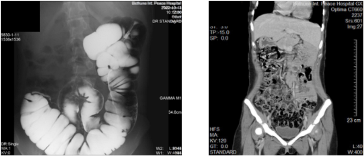 Frontiers | An adult female patient with single atrium and single ...