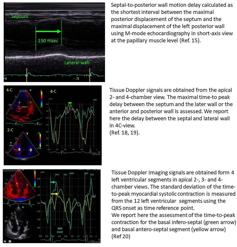 Frontiers | The saga of dyssynchrony imaging: Are we getting to the point