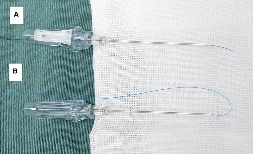 Frontiers | Endoscopic percutaneous repair of laryngeal cleft