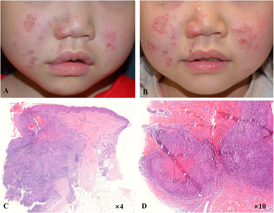 Frontiers | Case report: Rubella virus-induced cutaneous granulomas in ...