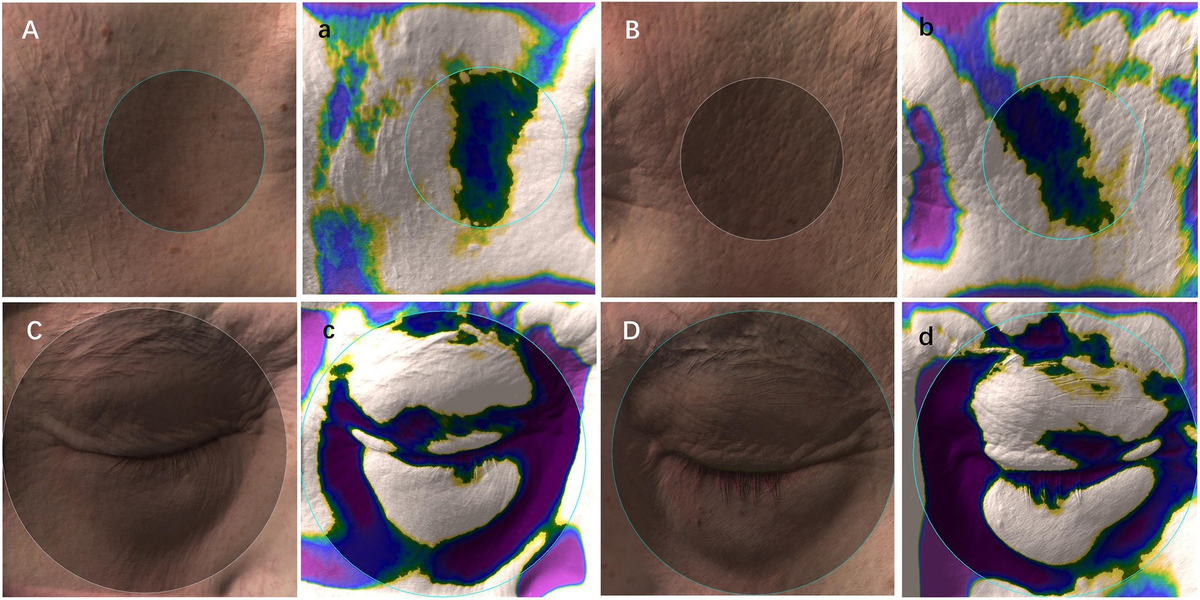 Frontiers | Temporal and periorbital depressions identified by 3D ...