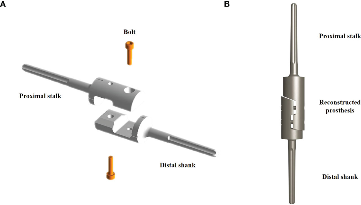 Frontiers | Clinical efficacy of customized modular prosthesis in the ...