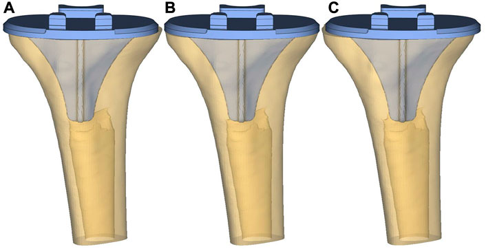 Frontiers | Medial-lateral translational malalignment of the prosthesis ...