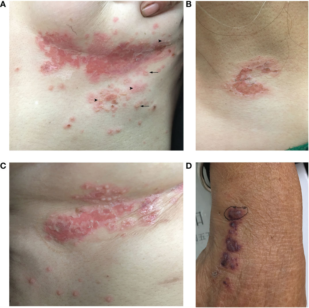 Frontiers | Case report: Vesiculobullous eruption with an atypical IgA ...