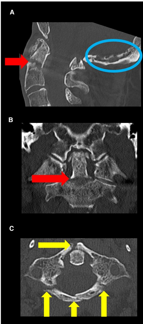Frontiers | Case report: Interdisciplinary treatment of complex C1/C2 ...