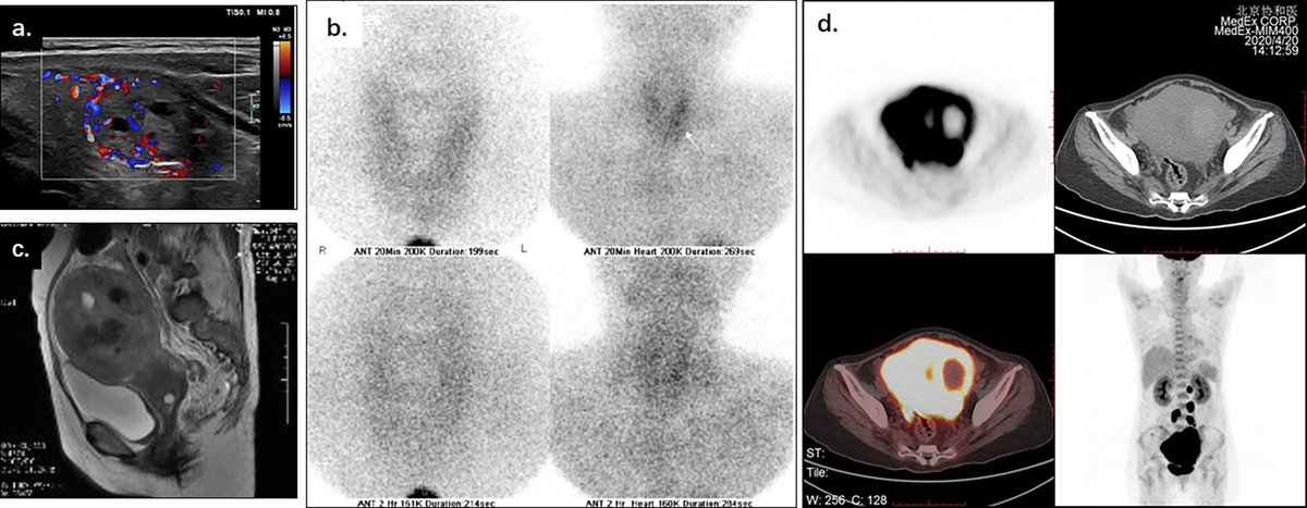 Frontiers | Case Report: Life-threatening hypercalcemia associated with ...