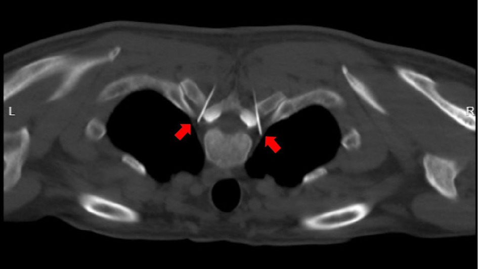 Frontiers | Comparison of CT-guided thoracic sympathetic nerve block ...
