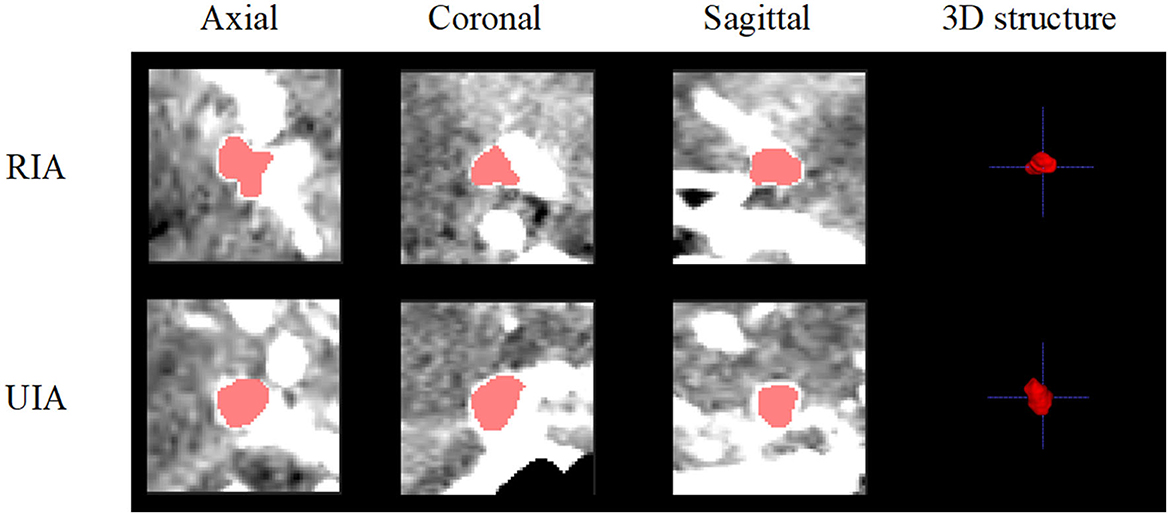 Frontiers | Automatic risk prediction of intracranial aneurysm on CTA ...