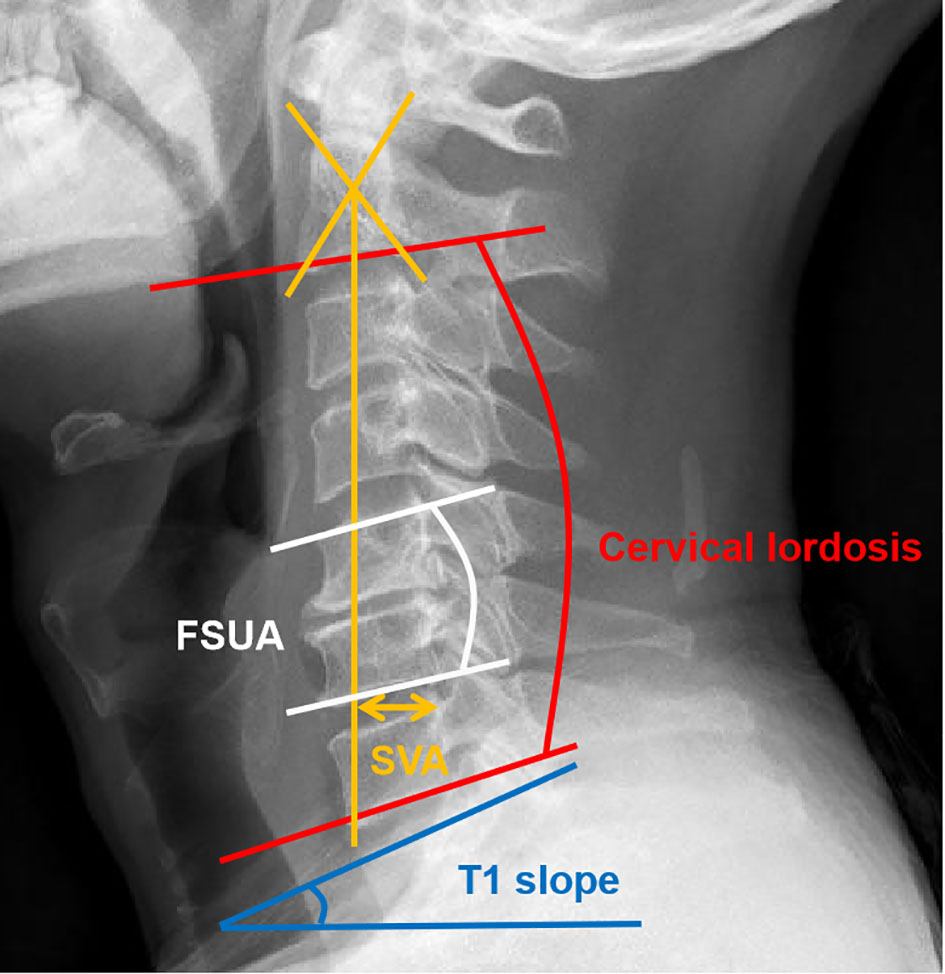Frontiers | The fatty infiltration into cervical paraspinal muscle as a ...